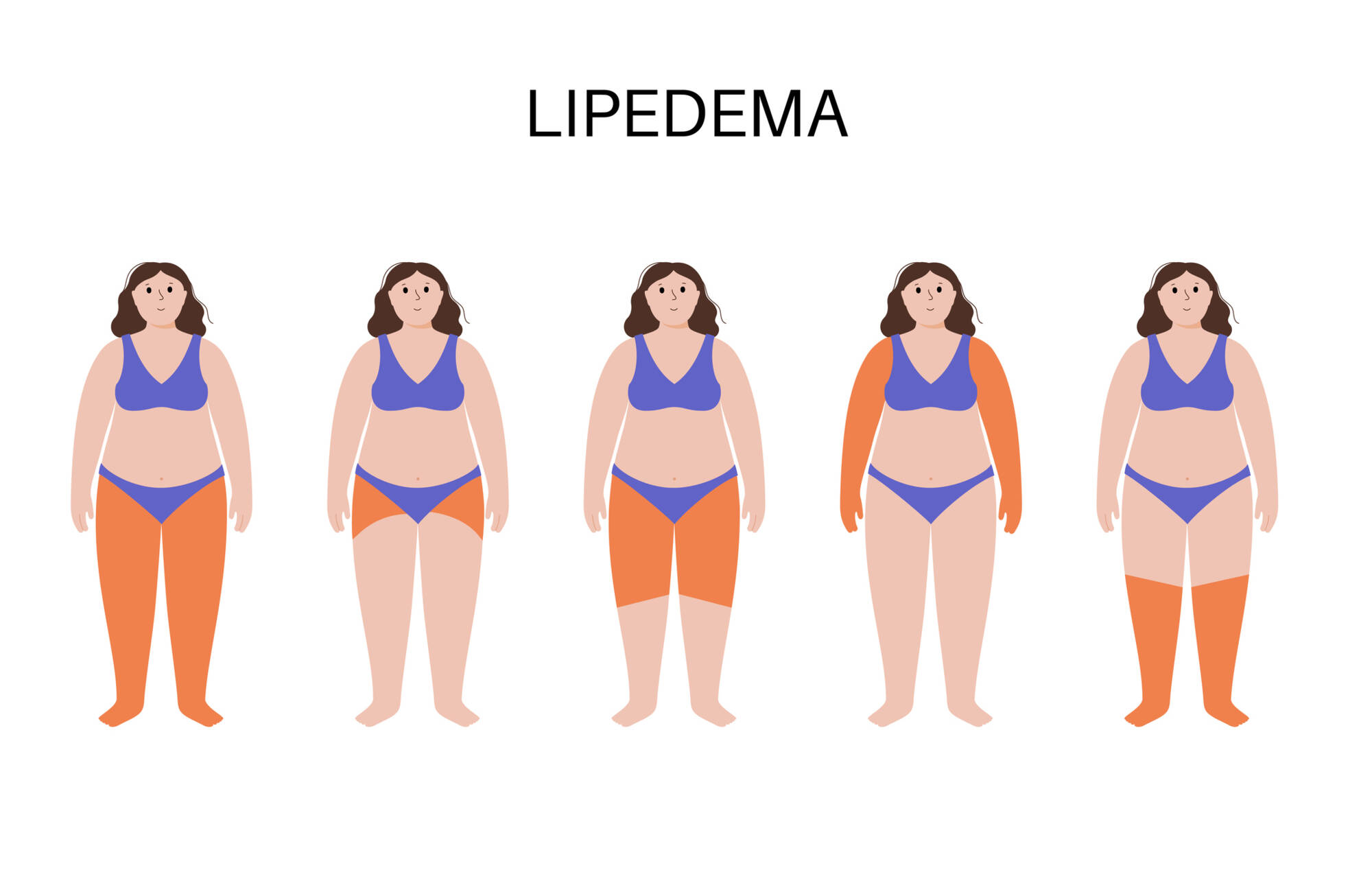 ONG lança campanha de conscientização sobre lipedema ONG lança campanha de conscientização sobre lipedema